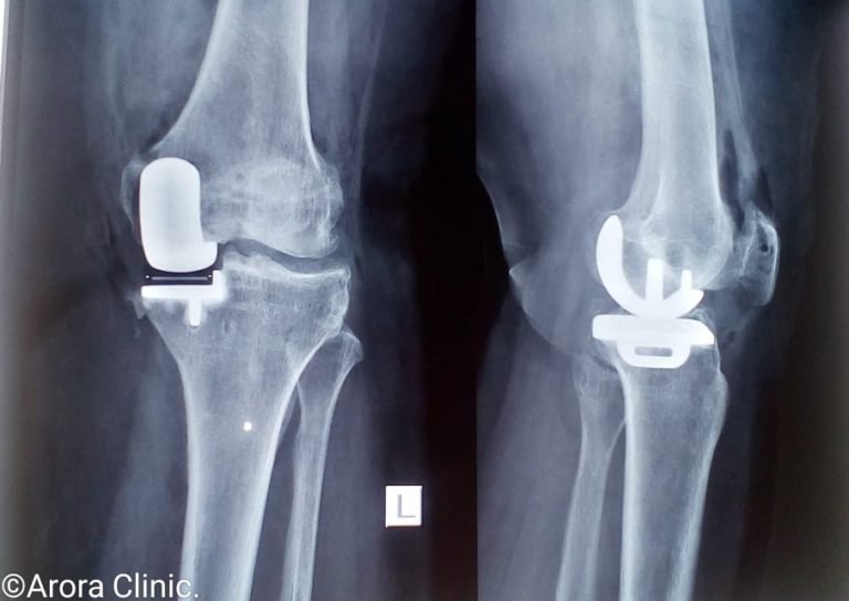Partial knee Replacement Surgery | Dr. Bakul Arora | Arora Clinic