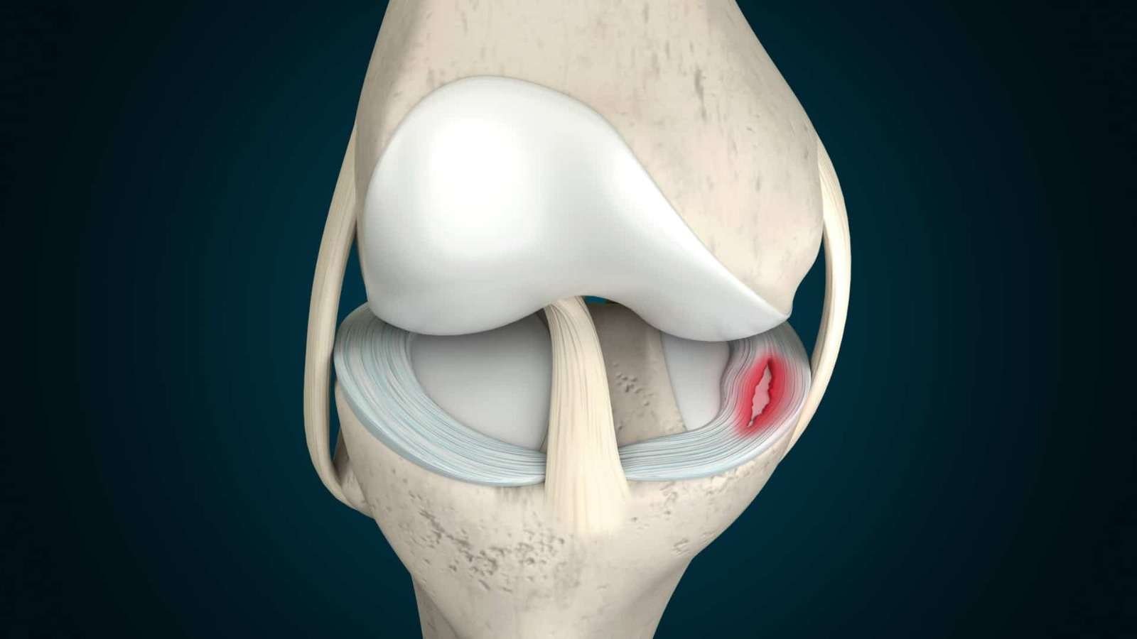 Arthroscopic Meniscus Repair Surgery Arora Clinic